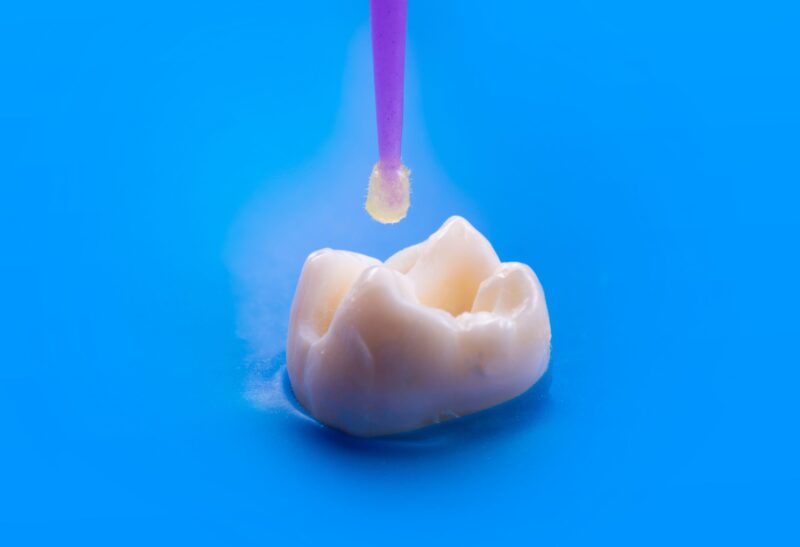 Dental Bonding Mobile AL - Benefits and Procedure